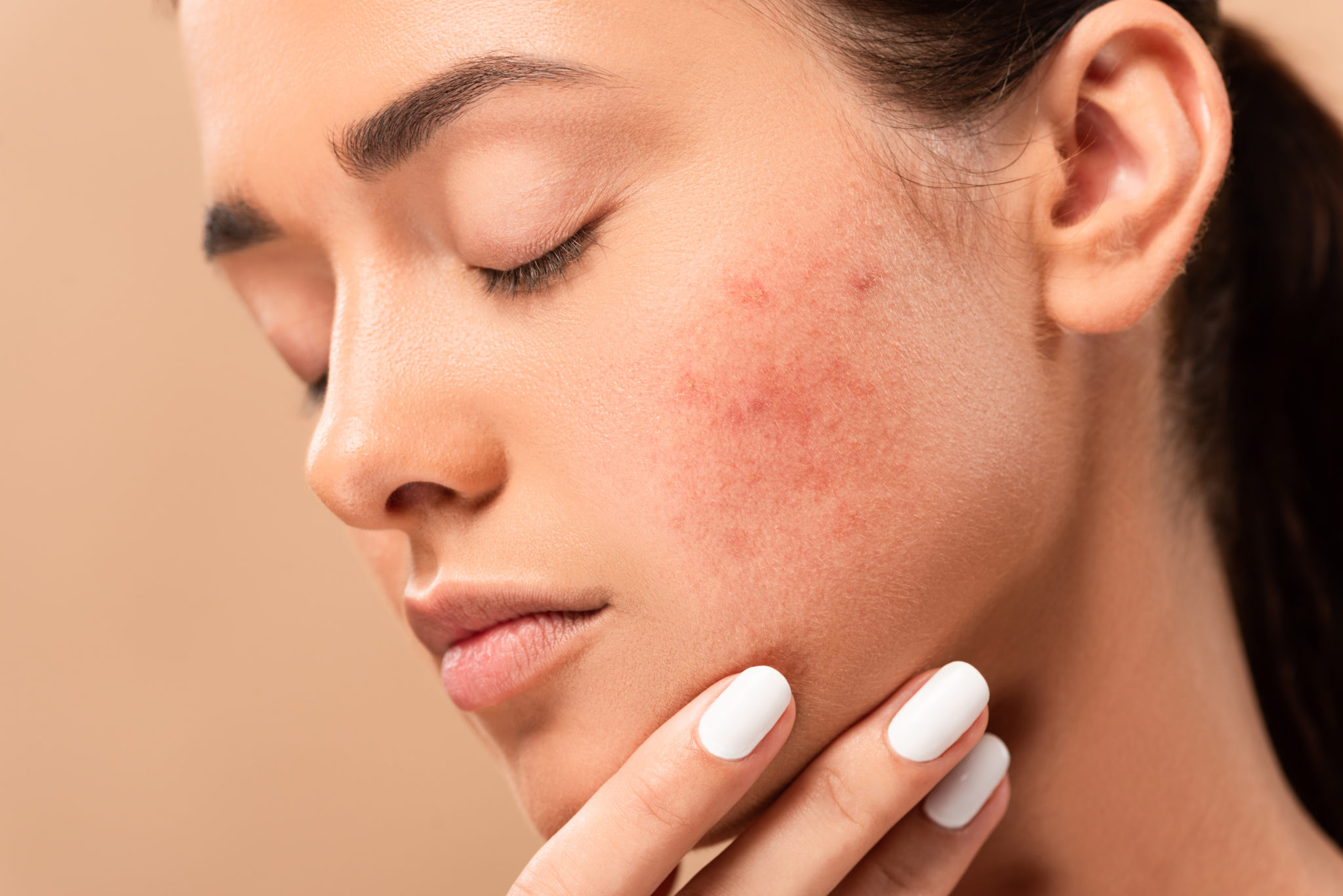 Quick Tips on How to Get Rid of Cheek Acne Fast - The Parent Gadget